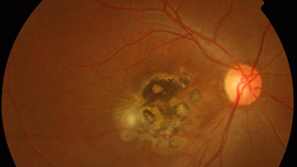 Role of immune cells in macular scarring development explored